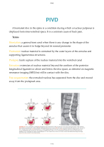 Posterior Intervertebral Disc Prolapse - DocMerit