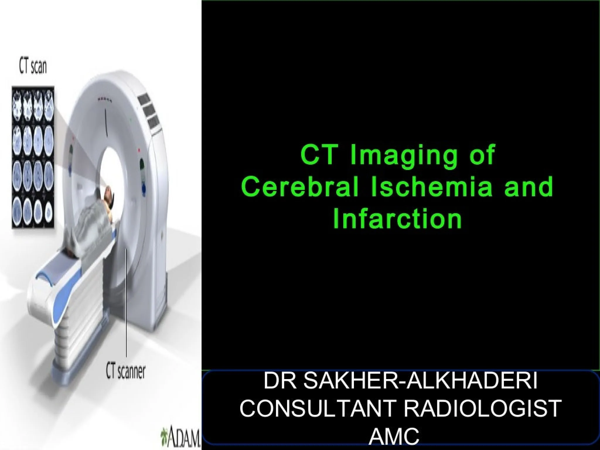CT Imaging-of-cerebral-ischemia-and-infraction - DocMerit